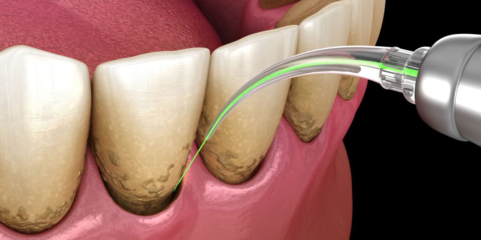LANAP® Laser Gum Surgery | Durham & Raleigh, NC | Periodontics & Dental ...